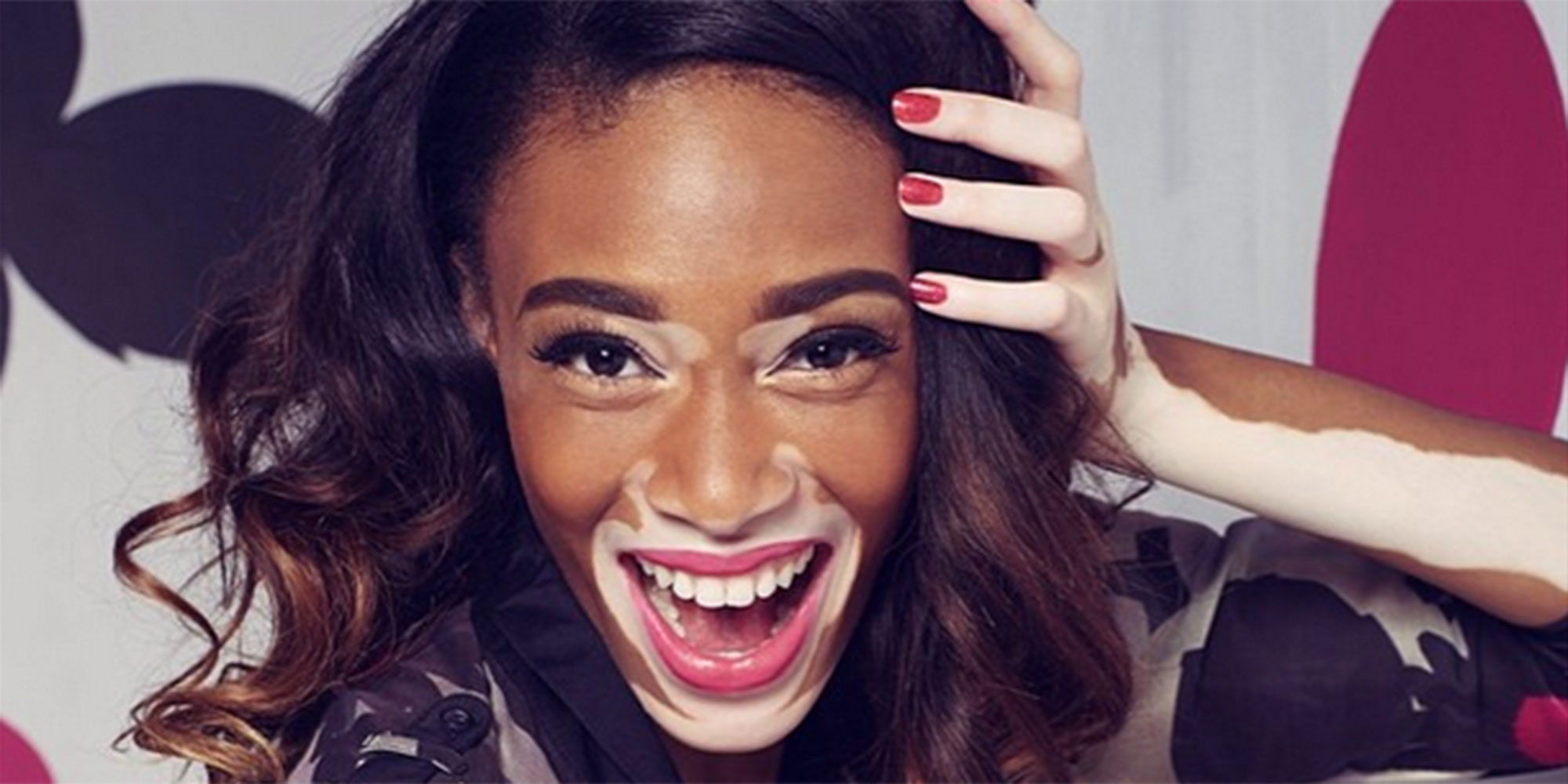 America's Next Top Model contestant and 'Vitiligo Spokesmodel' Winnie ...
